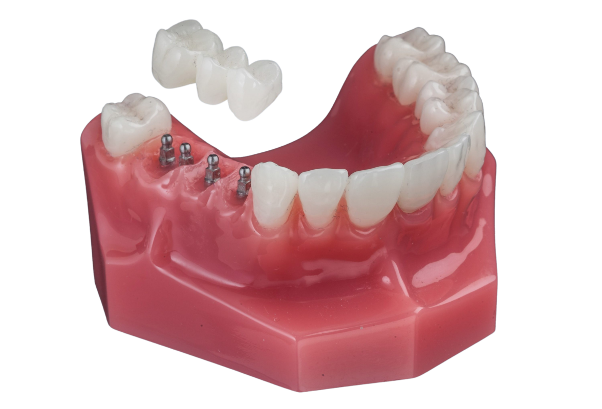 Dental Bridges vs. Partial Dentures | Mini Implants in Buffalo, NY