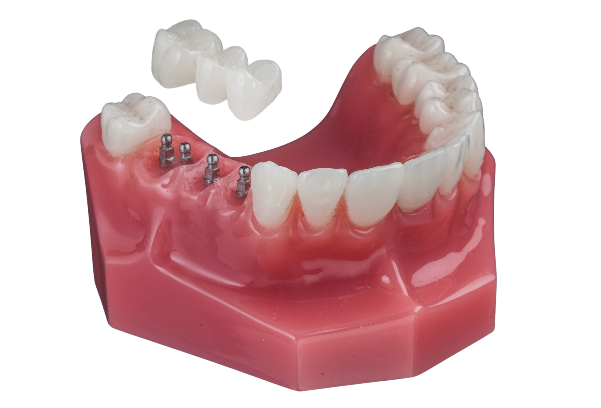 Dental Bridges vs. Partial Dentures | Mini Implants in Buffalo, NY