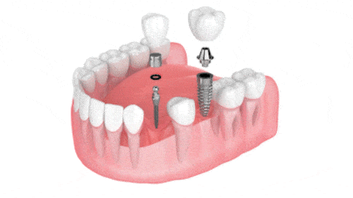 Mini Dental Implants vs Conventional Implants | Dr. Todd Shatkin